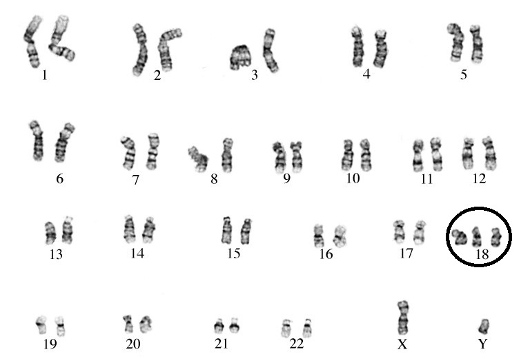 Chromosomes (Structure, types, functions and disorders) - Online ...