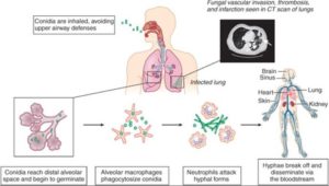 Mucormycosis (The black fungus infection): Causal agents and their ...
