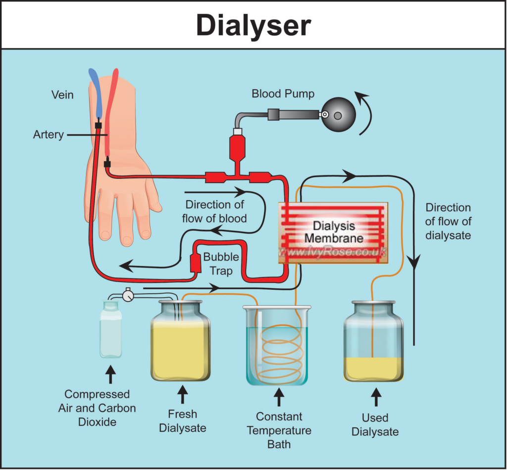 Artificial kidneys: Hemodialysis therapy - Online Science Notes